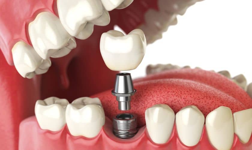 How Many Dental Implants Are Needed for Six Teeth?